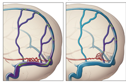 angiografie embolisatie durale fistel - UMC Utrecht