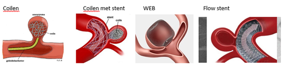 angiografie endovasculaire behandeling hersenaneurysma - UMC Utrecht