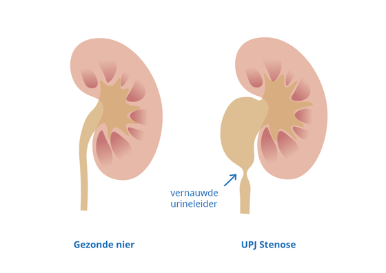 UPJ Stenose - Het WKZ