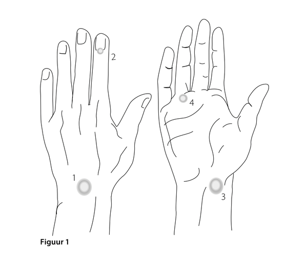 Ganglion cysten - UMC Utrecht