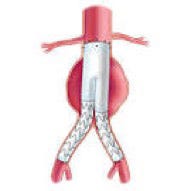 Operatie van de buikslagader via de liesslagader - UMC Utrecht