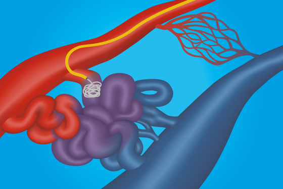 interventieradiologie bij neuro-interventie - UMC Utrecht