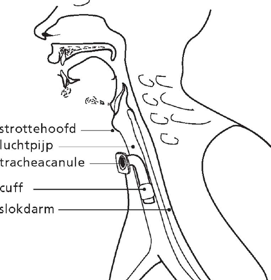 Tracheostoma - UMC Utrecht