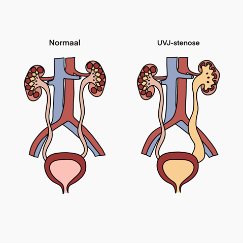 UVJ stenose - Het WKZ