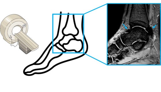Unnoticed joint bleeding in people with haemophilia (BEGIN study) - UMC ...