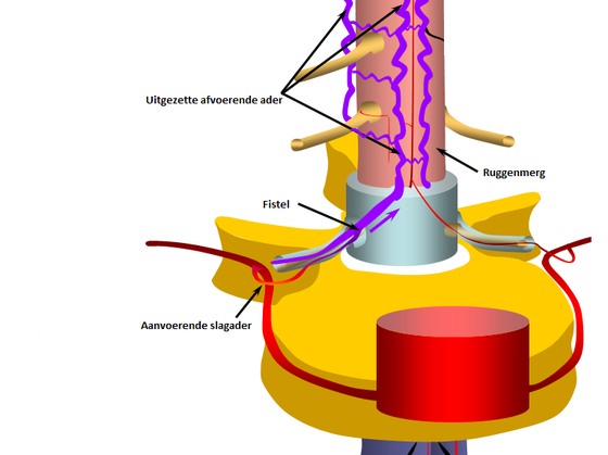 angiografie embolisatie spinale fistel - UMC Utrecht