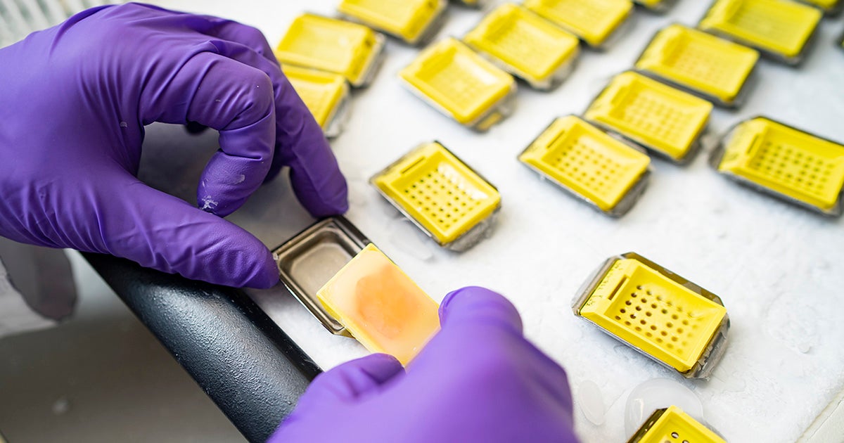 Test voor opsporen erfelijke borstkanker - UMC Utrecht