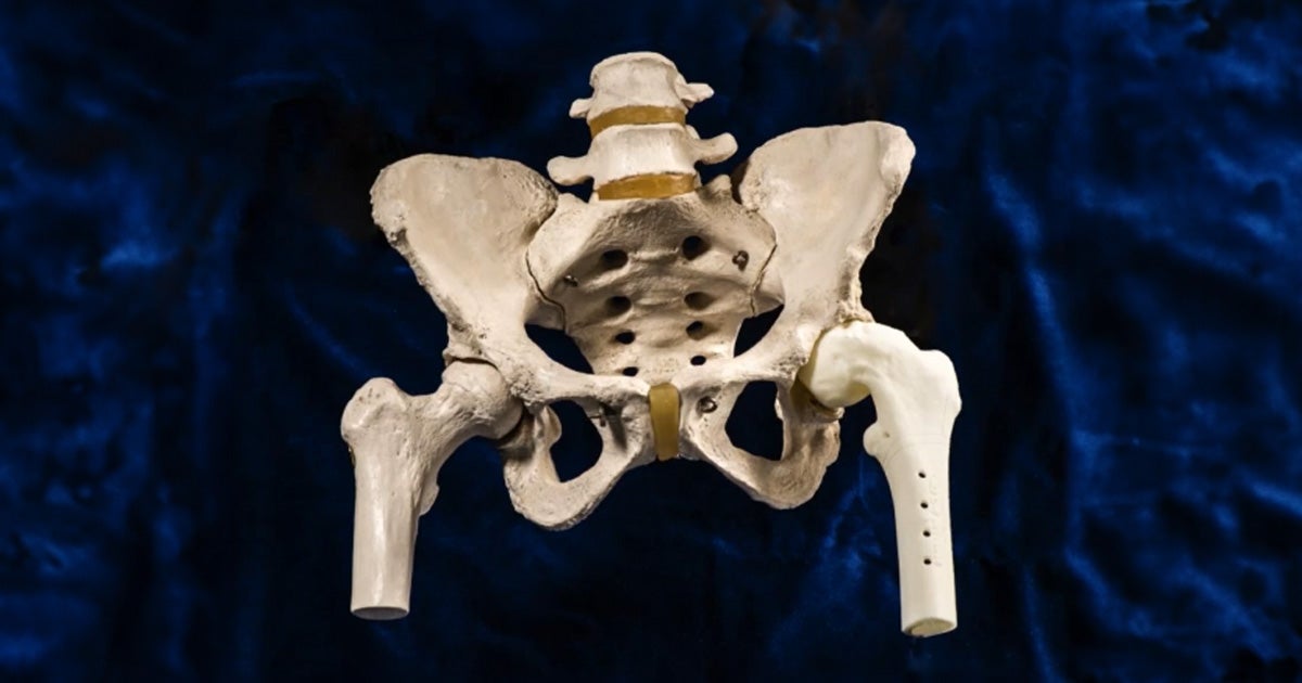 Webinar: Patient-Specific Guides for Corrective Osteotomies