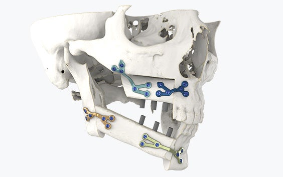 Reconstructive Surgery | Cranio-Maxillofacial Solutions | Materialise