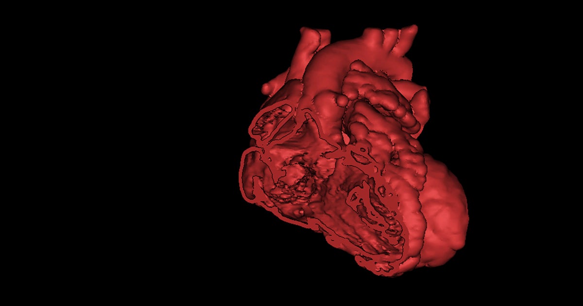 3D Personalized Predictions for Congenital Heart Disease Patients
