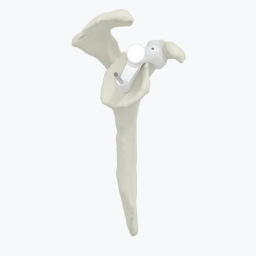 Personalized 3D Planning and Guides for Shoulder Arthroplasty