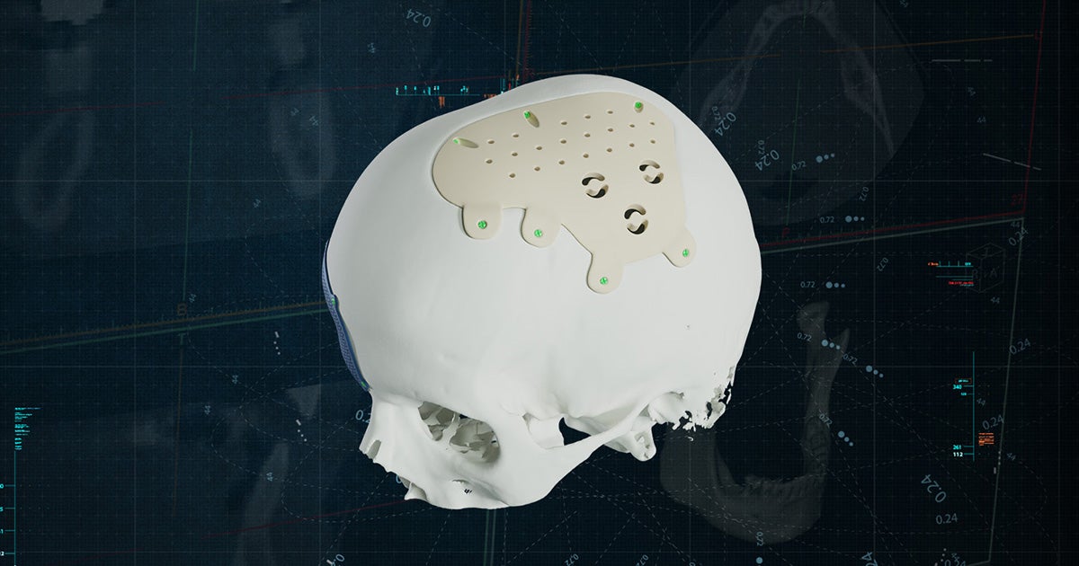 Reconstruction crânienne - Implants crâniens imprimés en 3D et ...