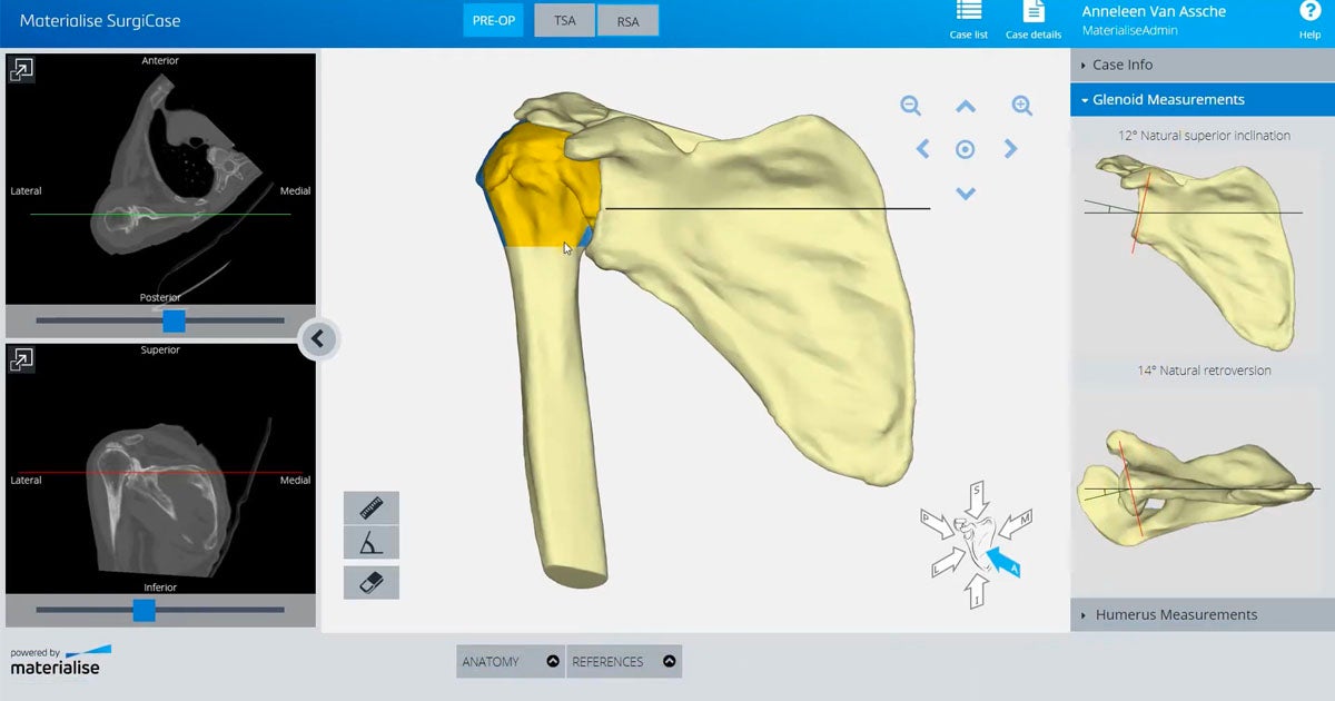 Video: Online 3D Planning and Ordering of 3D-printed Shoulder Guides