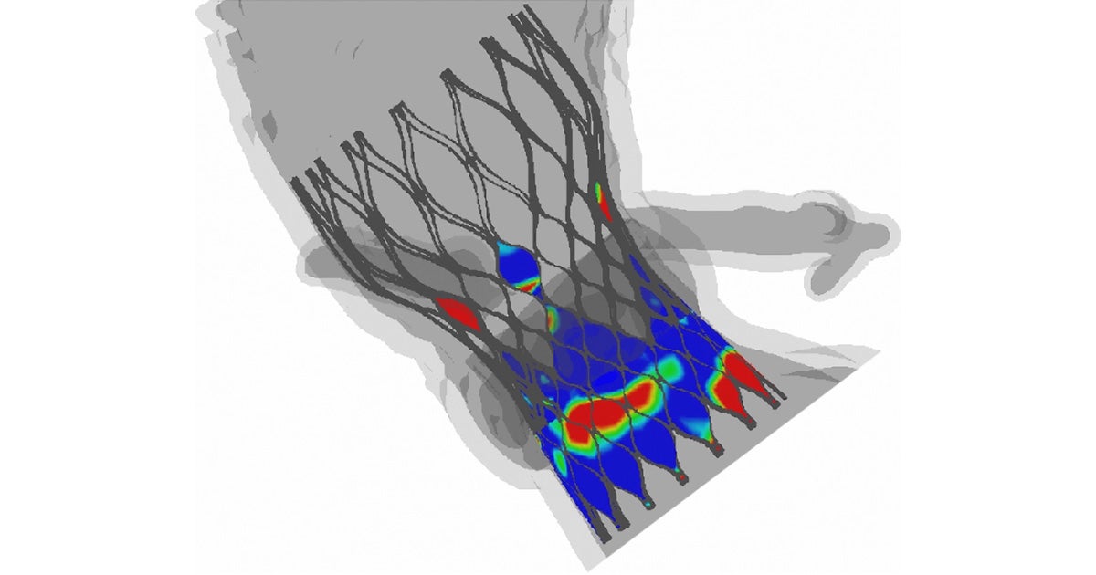 Patient-Based Cardiovascular Device Simulations: From Bench to Bed