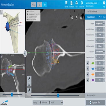 Personalized 3D Planning and Guides for Shoulder Arthroplasty