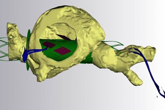 Tricuspid Valve Replacement: 3D Technology Accelerates Life-Saving Ideas