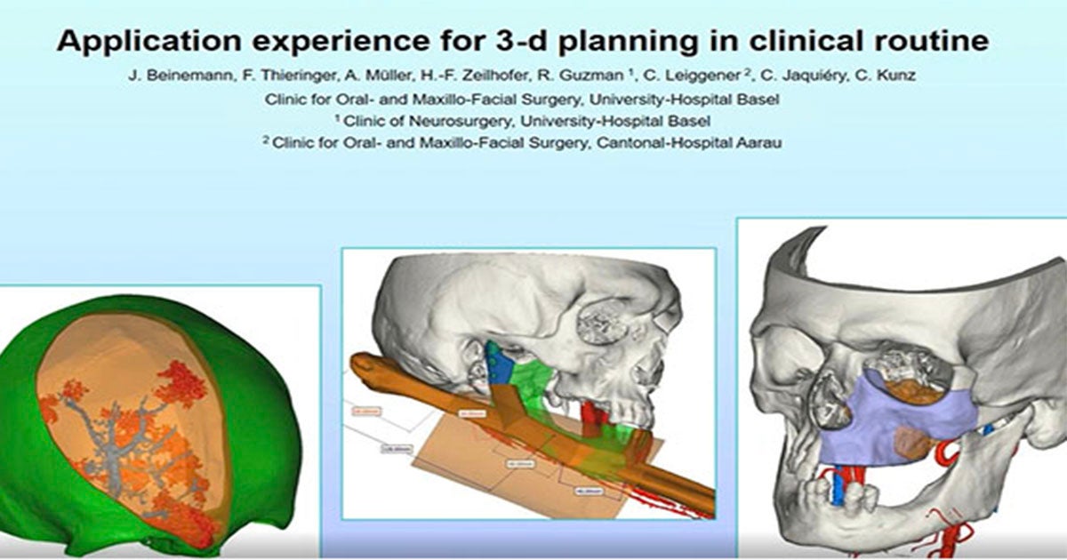 Empowering Surgeons with Virtual In-House Planning in CMF