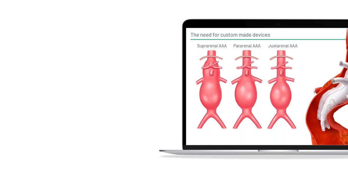 Bringing Personalized Medical Devices to the Masses: How Terumo Aortic ...