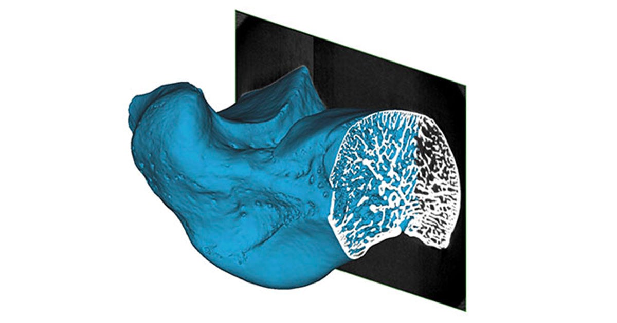 Webinar: Maintain Accurate Bone Geometries in FEA Meshes