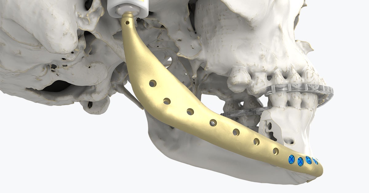 Advancing TMJ Arthroplasty Surgery: Precision Solutions for Tumor ...