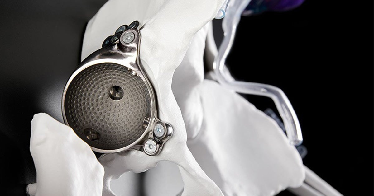 Patient-Specific Implant for Post-Traumatic Acetabular Defect ...