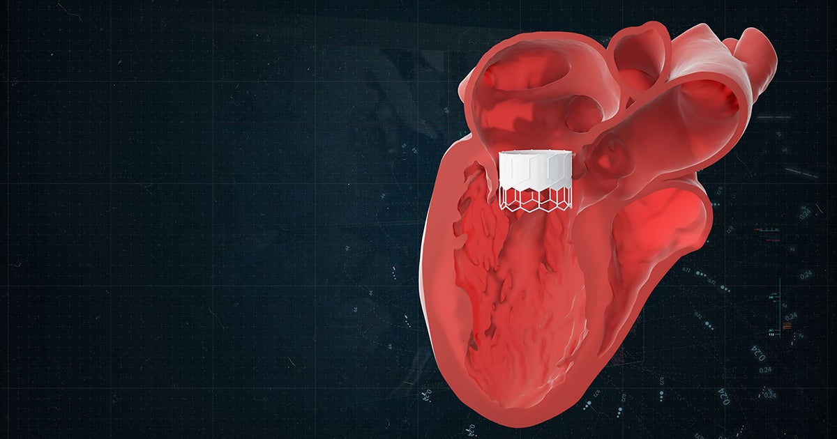 Materialise Expands Cardiovascular Capabilities through FEops Acquisition