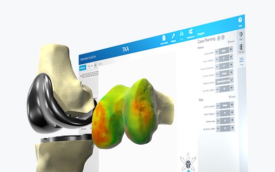 Knee Guides Precisely Execute Personalized TKA Alignment