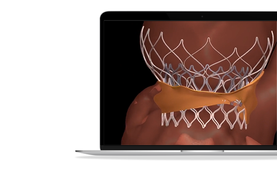 Cardiovascular Device Innovation with FEops' Simulation Technology
