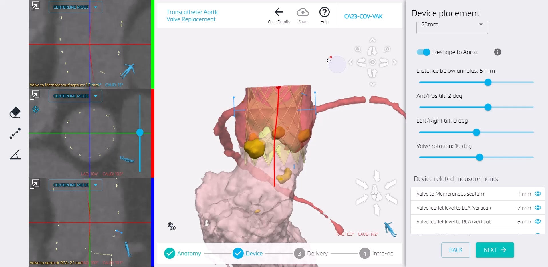 Mimics Planner for Structural Heart Interventions | Advanced 3D Modeling