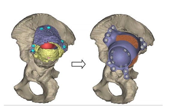 Acetabular Reconstructions in Patients with Severe Defects: Literature ...