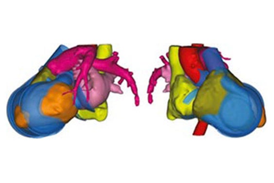 Creating the Perfect Fit for a Pulsatile Total Artificial Heart