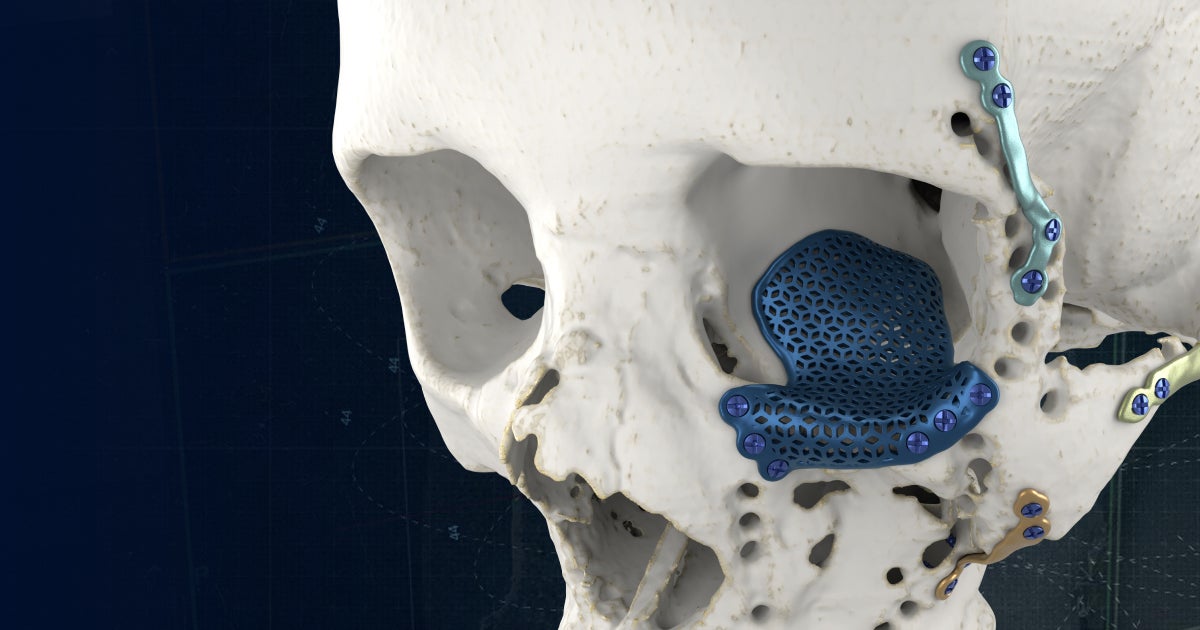 Trauma | 3D Guides and 3D Personalized Trauma Implants