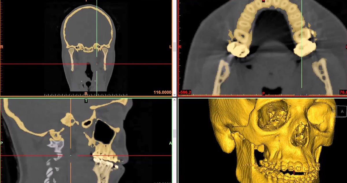 Mimics inPrint ビギナー向けウェビナー vol.4 頭蓋・顎顔面
