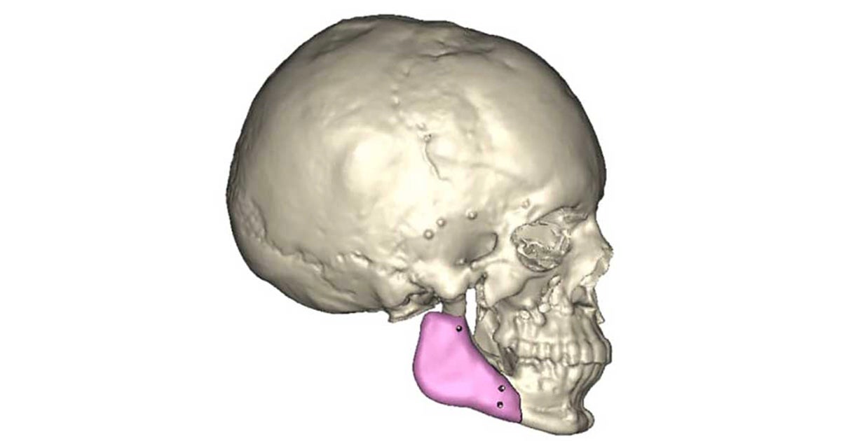 Revolutionizing cranio-maxillofacial surgeries with 3D planning and ...
