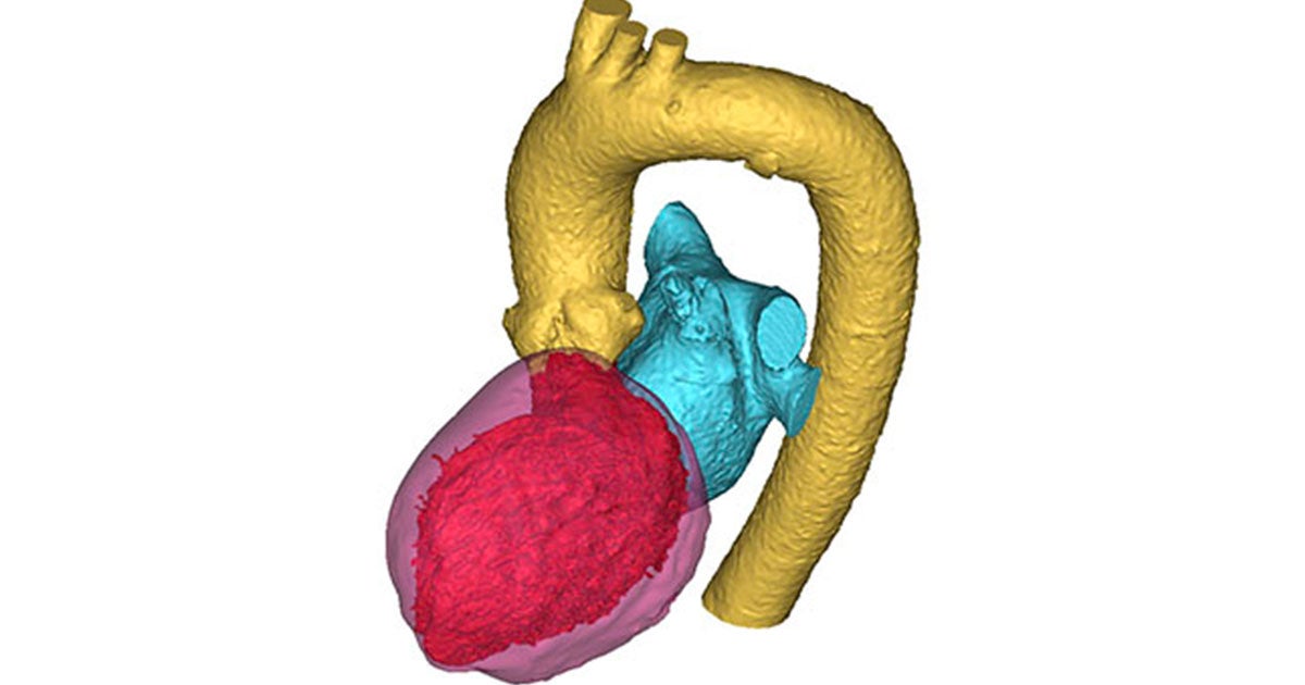 Webinar: Heart Segmentation -: Left Heart and Myocardium