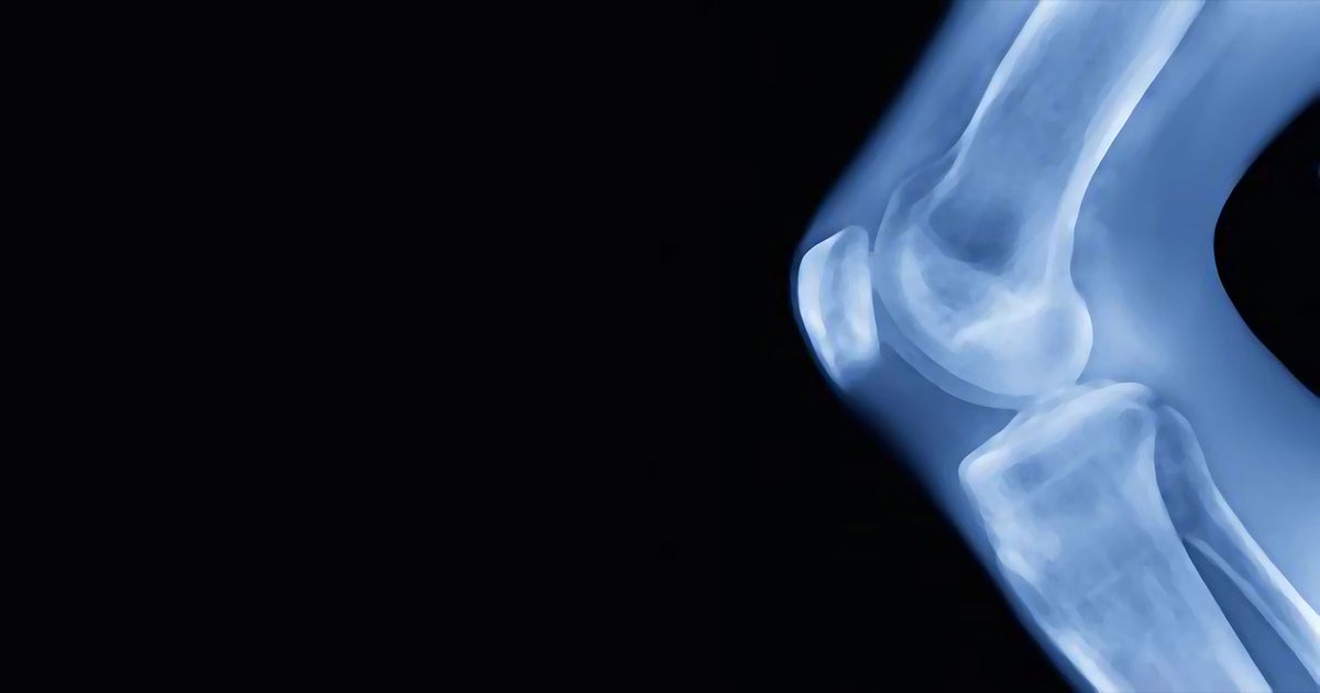 Accelerating Orthopaedic Device Development with Workflow Automation