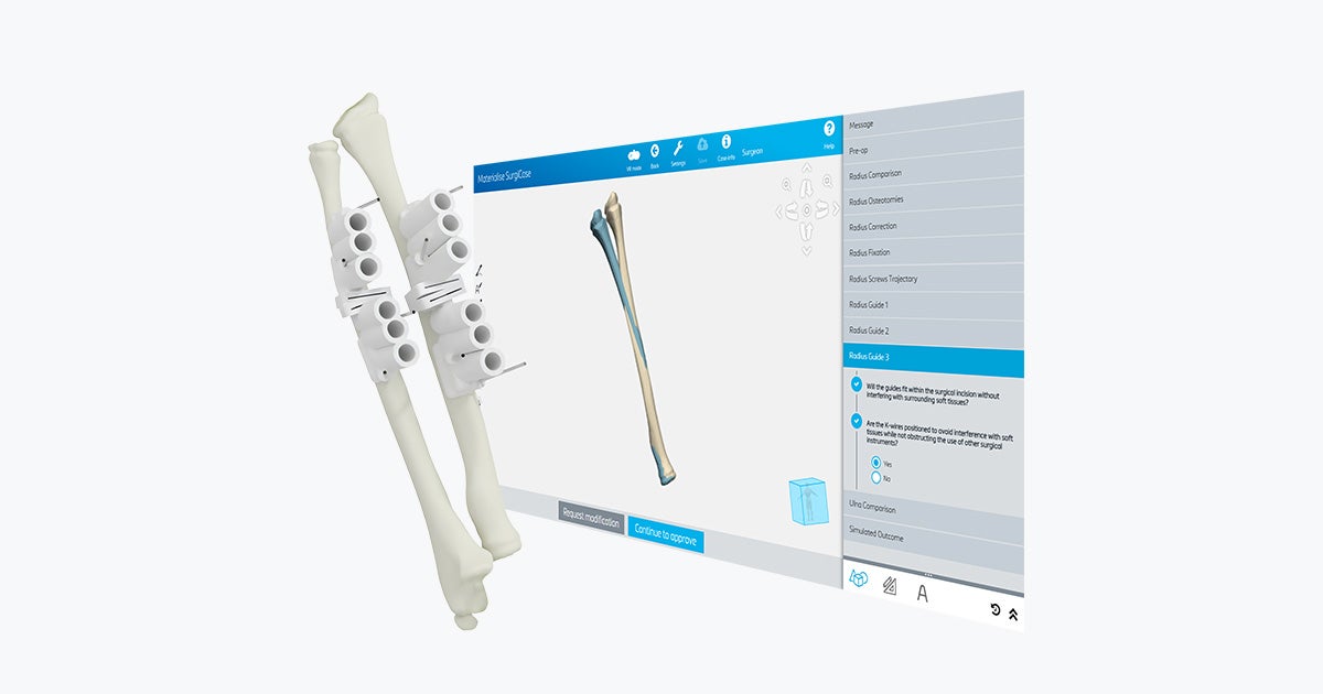 3D Planning and Guides for Osteotomies | Materialise