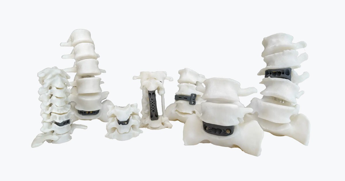 Fusing Technology to Create Life-Changing Custom Spine Implants