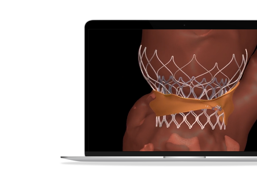 Cardiovascular Device Innovation with FEops' Simulation Technology