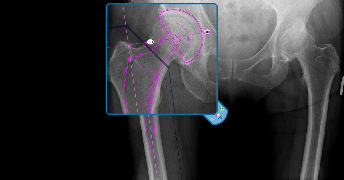 Study of Sizing Accuracy for Digitally Templating the Exeter Hip