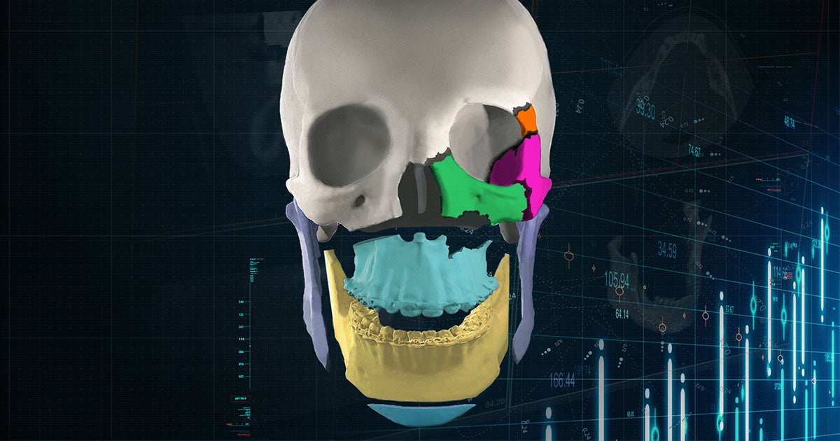 Materialise Mimics Enlight CMF | Virtual Surgical Planning