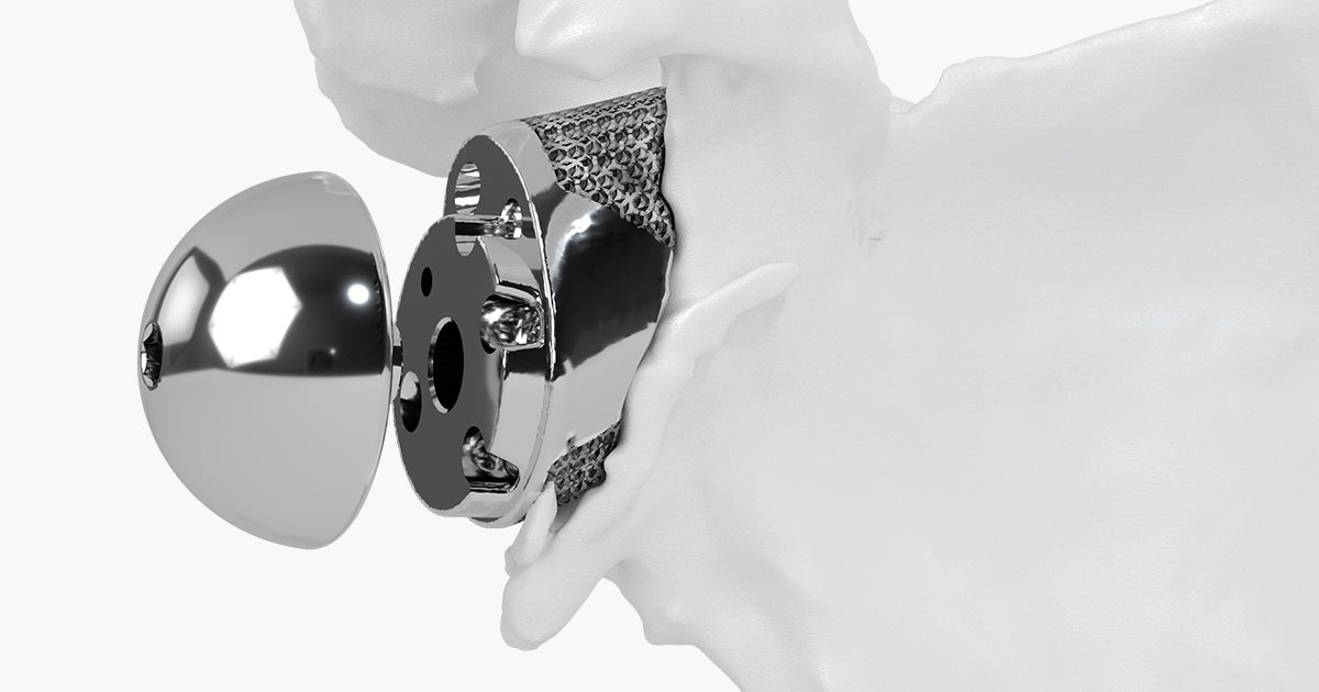 3D-Printed Shoulder Implant Renews Mobility Post-Gunshot Injury