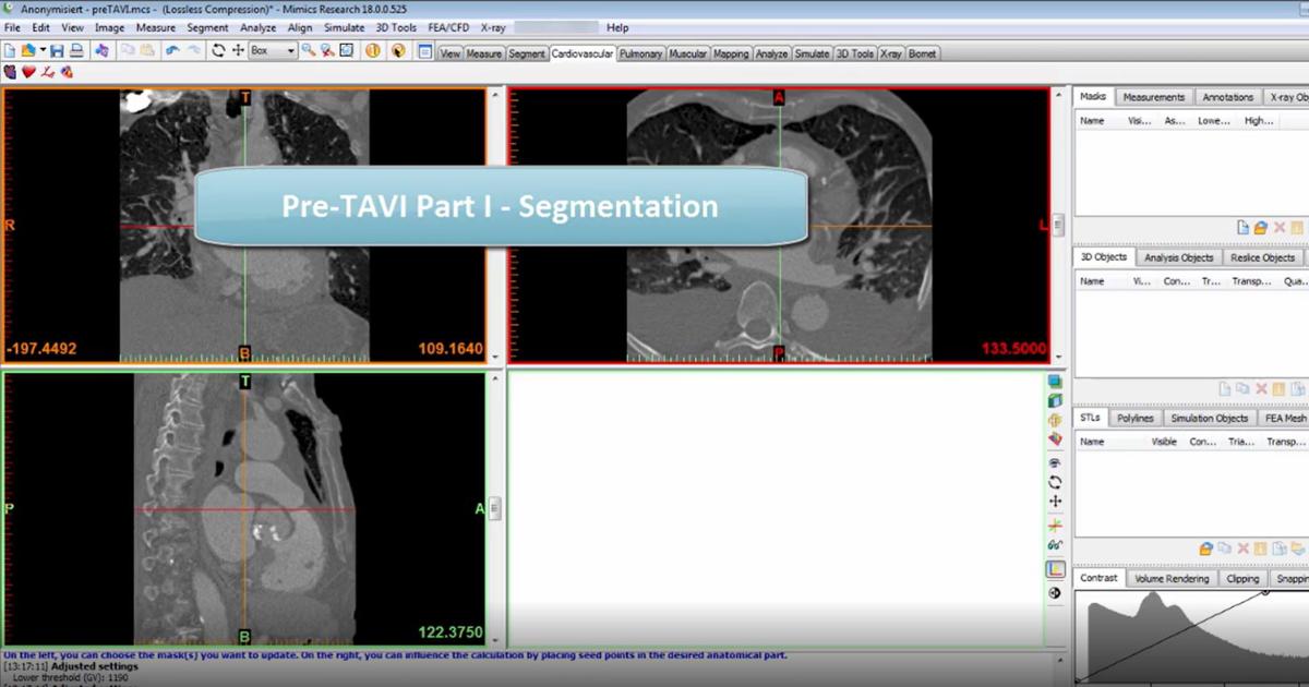Webinar: How to Assess the Aortic Valve to Plan for a TAVI