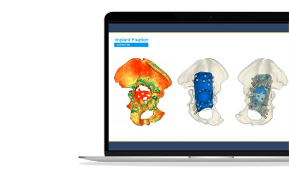 Webinar: Triflange Acetabular Revision Cups from an Anterior Approach