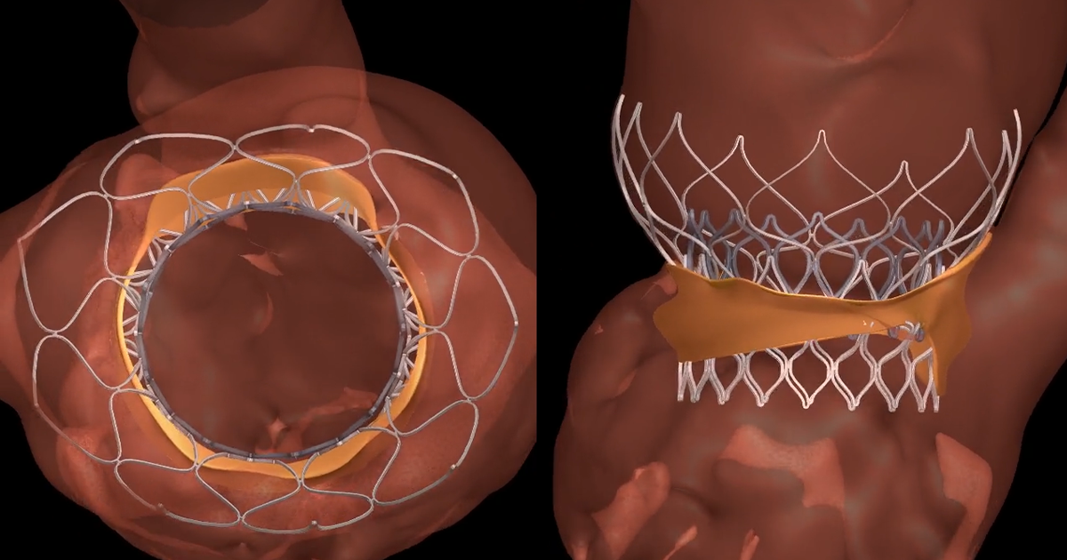 Cardiovascular Device Innovation with FEops' Simulation Technology