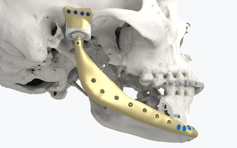 Webinar: Discover Materialise Mimics Enlight CMF