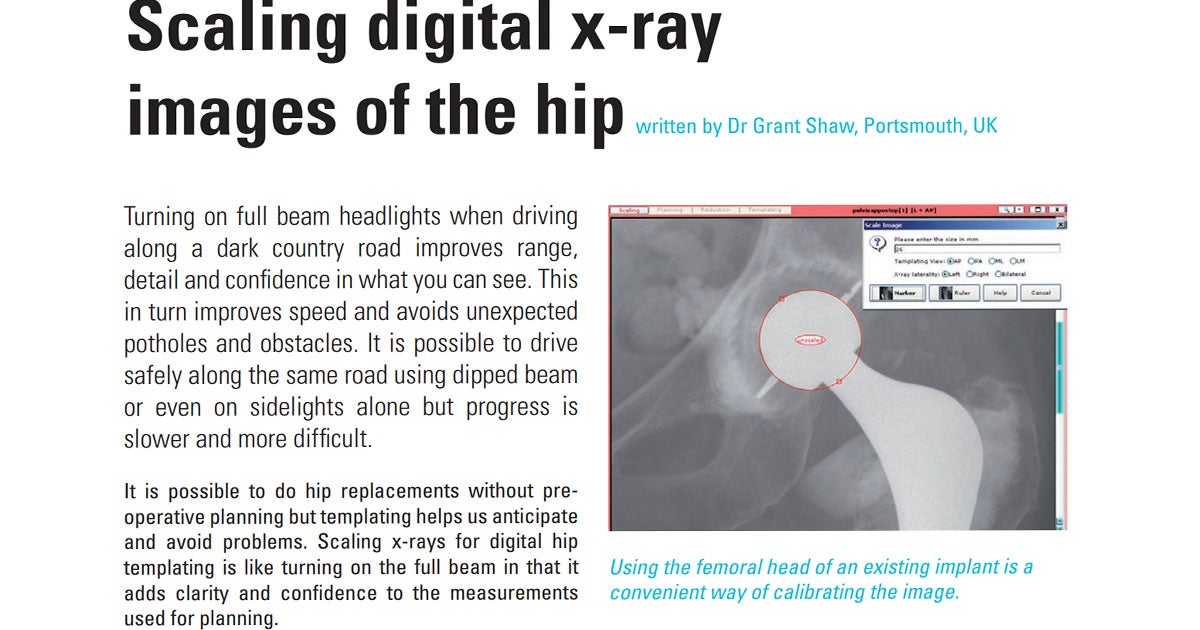 Scaling digital x-ray images of the hip Grant Shaw