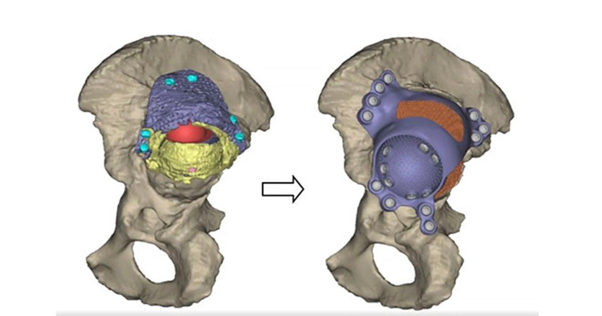 The Critical Role of 3D Printing in Hip Treatment: How Skeletal Stem ...
