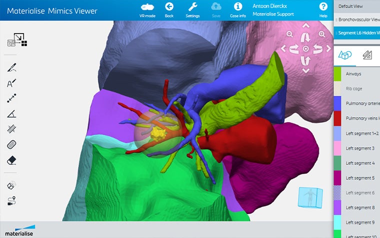 The Future of Thoracic Surgery: 3D Models on Intraoperative Video