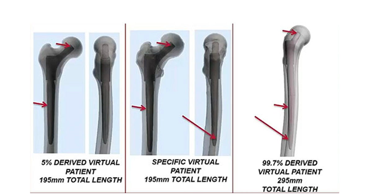 How virtual patients can accelerate implant development, exemplified by ...